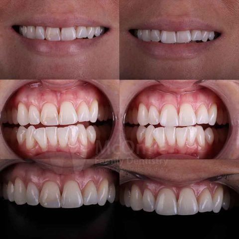 Veneers Patient Before and Afters - McOmie Family Dentistry