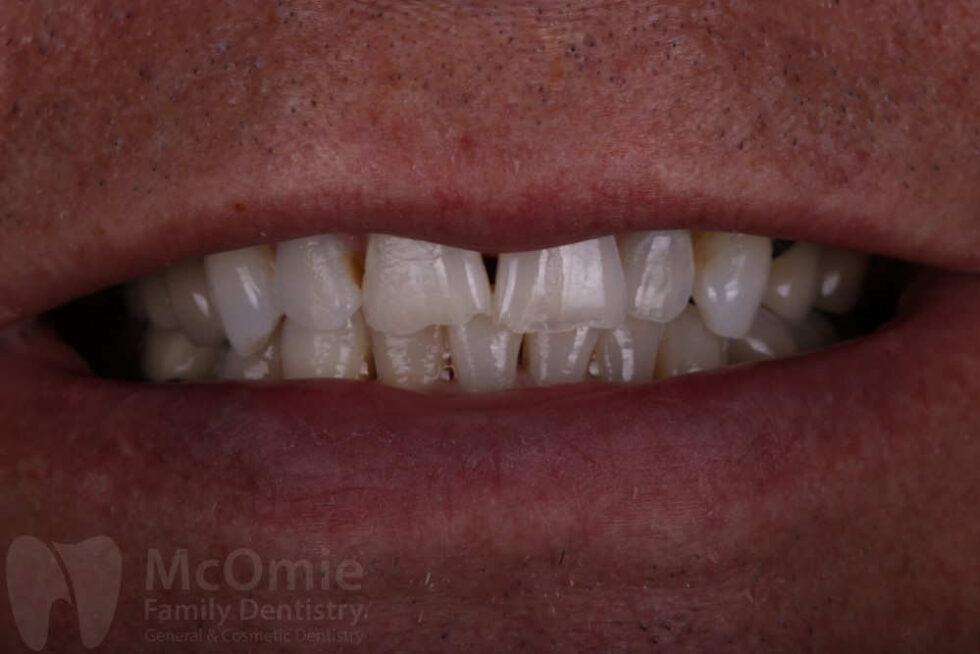 Veneers Patient Before and Afters - McOmie Dentistry Chattanooga