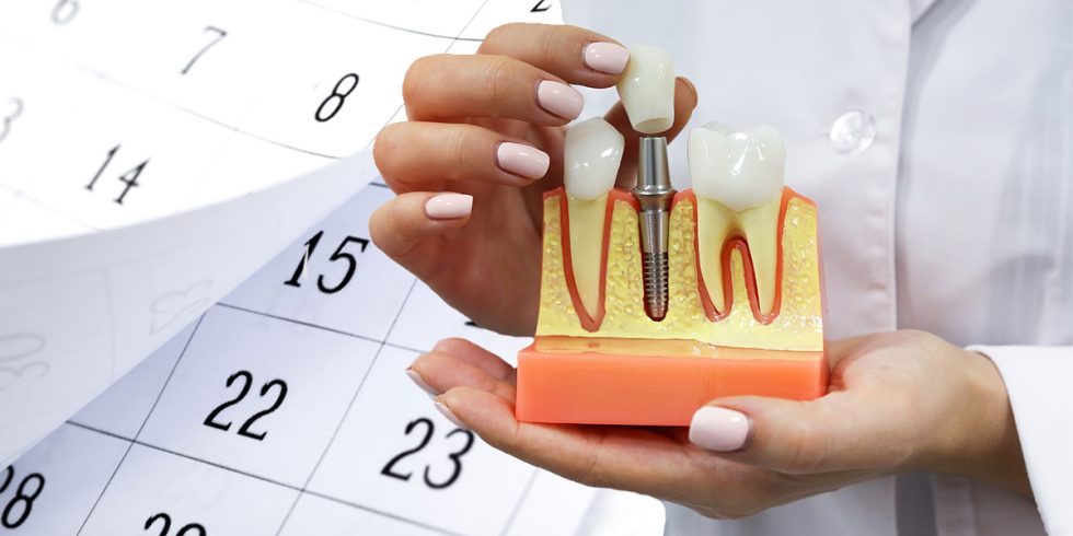 How Long Does The Dental Implant Process Take - McOmie Dentistry ...