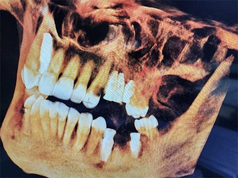 3D CBCT Imaging and its Impact on Dental Implant Procedures - McOmie ...