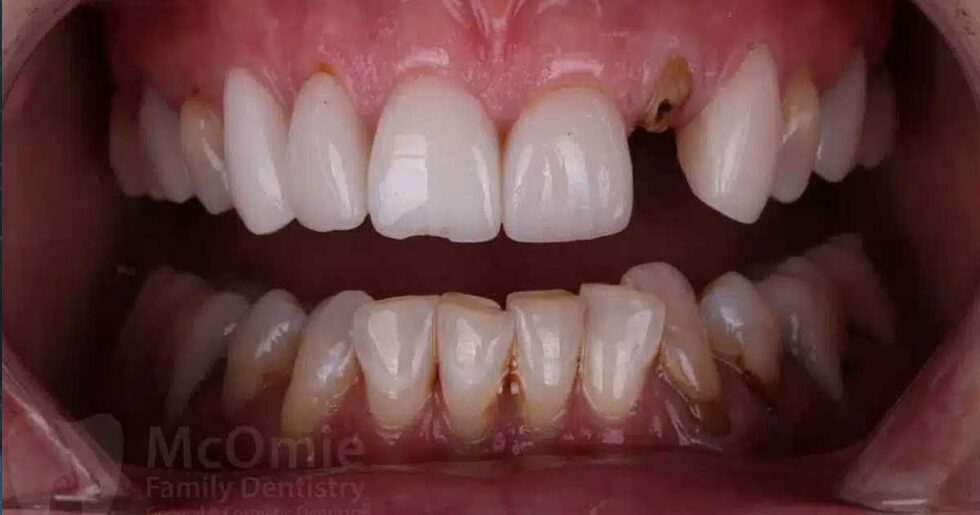 What to Do If Your Dental Crown Falls Off and What Not to Do - McOmie ...